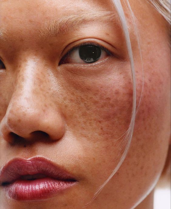 A Deep Dive into Hyperpigmentation: Causes and Treatments | AKT.THERAPY ...
